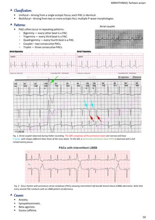Arrhythmia: Mechanism, Classification, ECG features | PDF