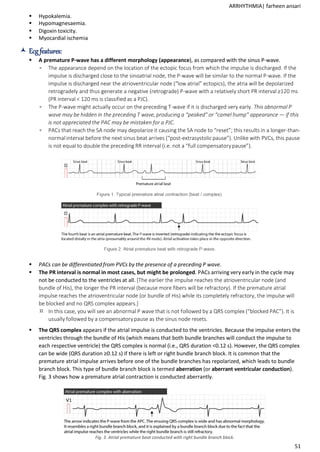 Arrhythmia: Mechanism, Classification, ECG features | PDF