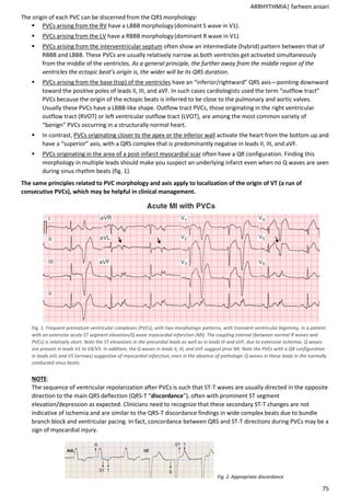 Arrhythmia: Mechanism, Classification, ECG features | PDF
