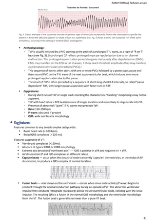 Arrhythmia: Mechanism, Classification, ECG features | PDF