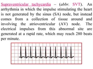 Arrhythmias | PPT