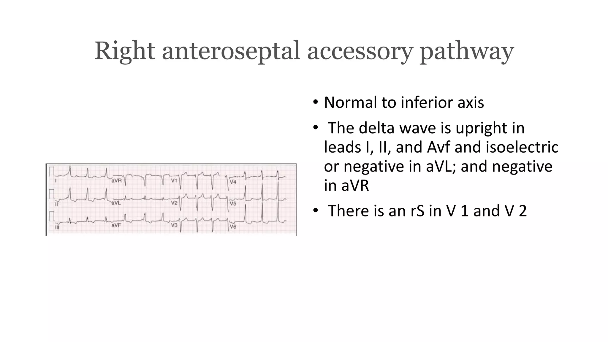Arrhythmias | PPTX