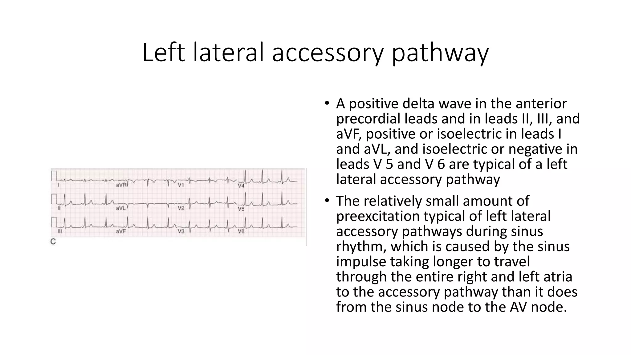 Arrhythmias | PPTX