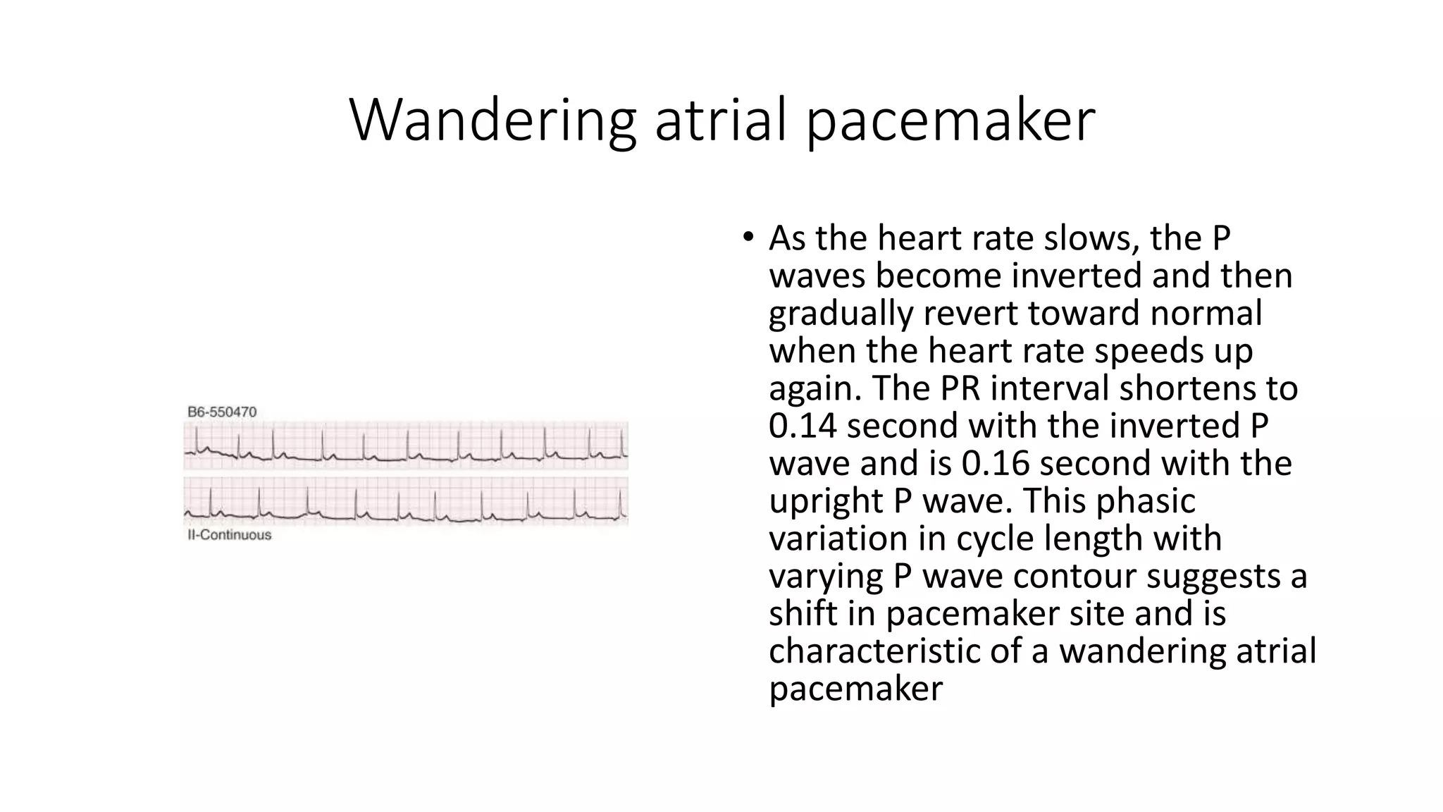 Arrhythmias | PPTX