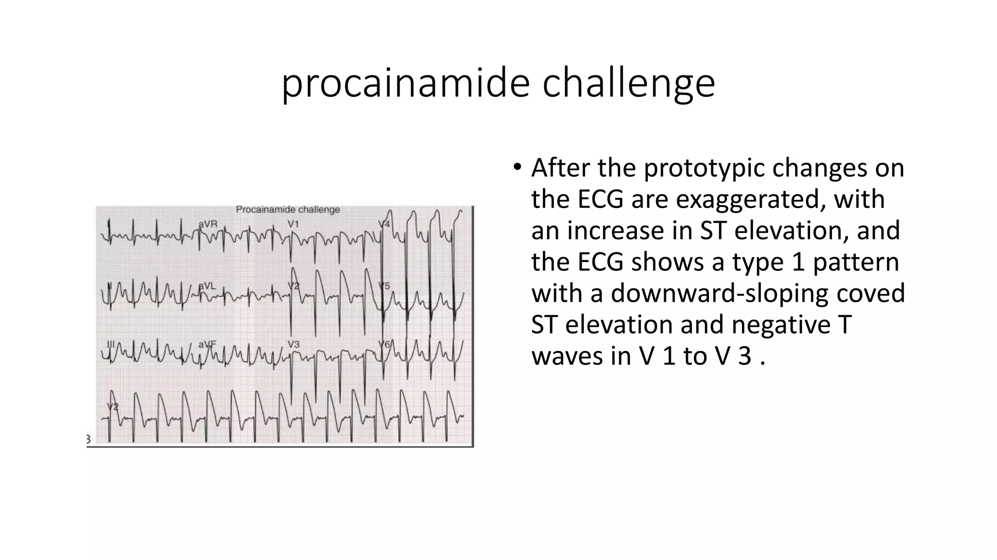 Arrhythmias | PPTX