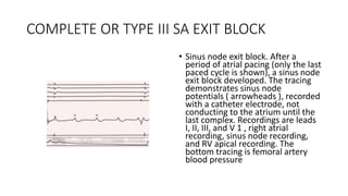 Arrhythmias | PPTX
