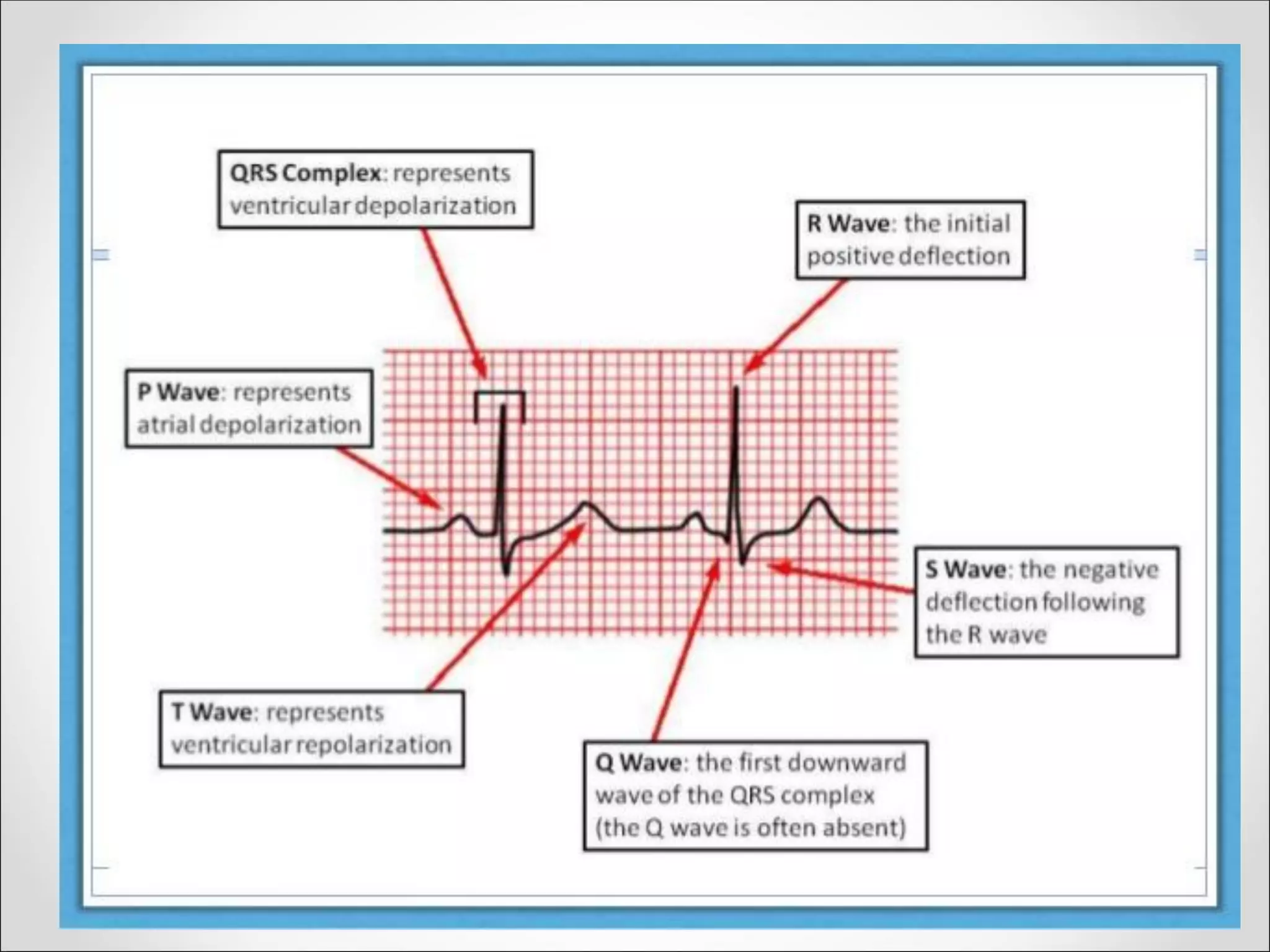 Arrhythmias | PDF
