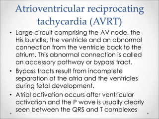 Arrhythmias | PDF