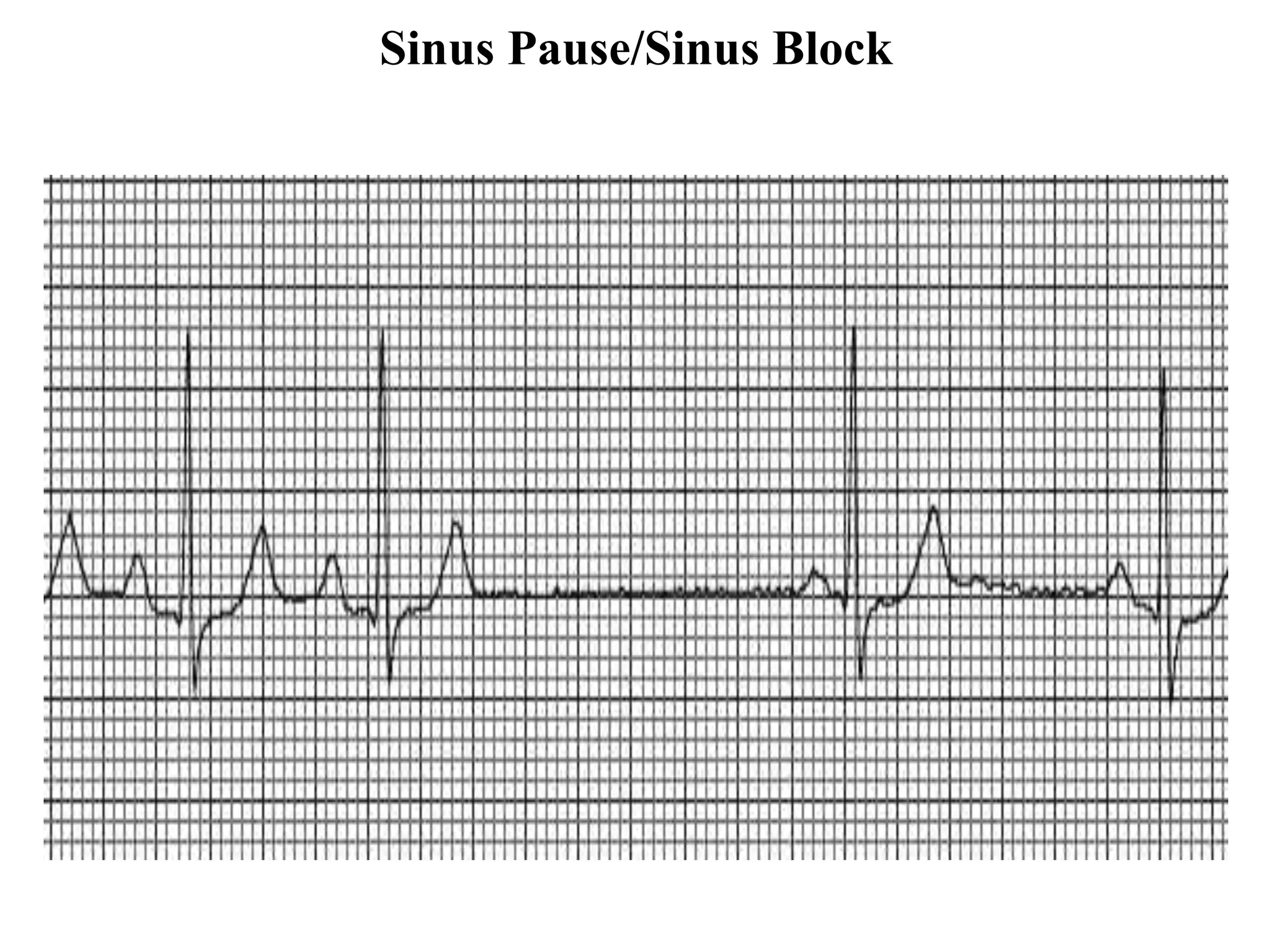 ARRHYTHMIAS ,causes, abnormal impulse conduction, | PDF