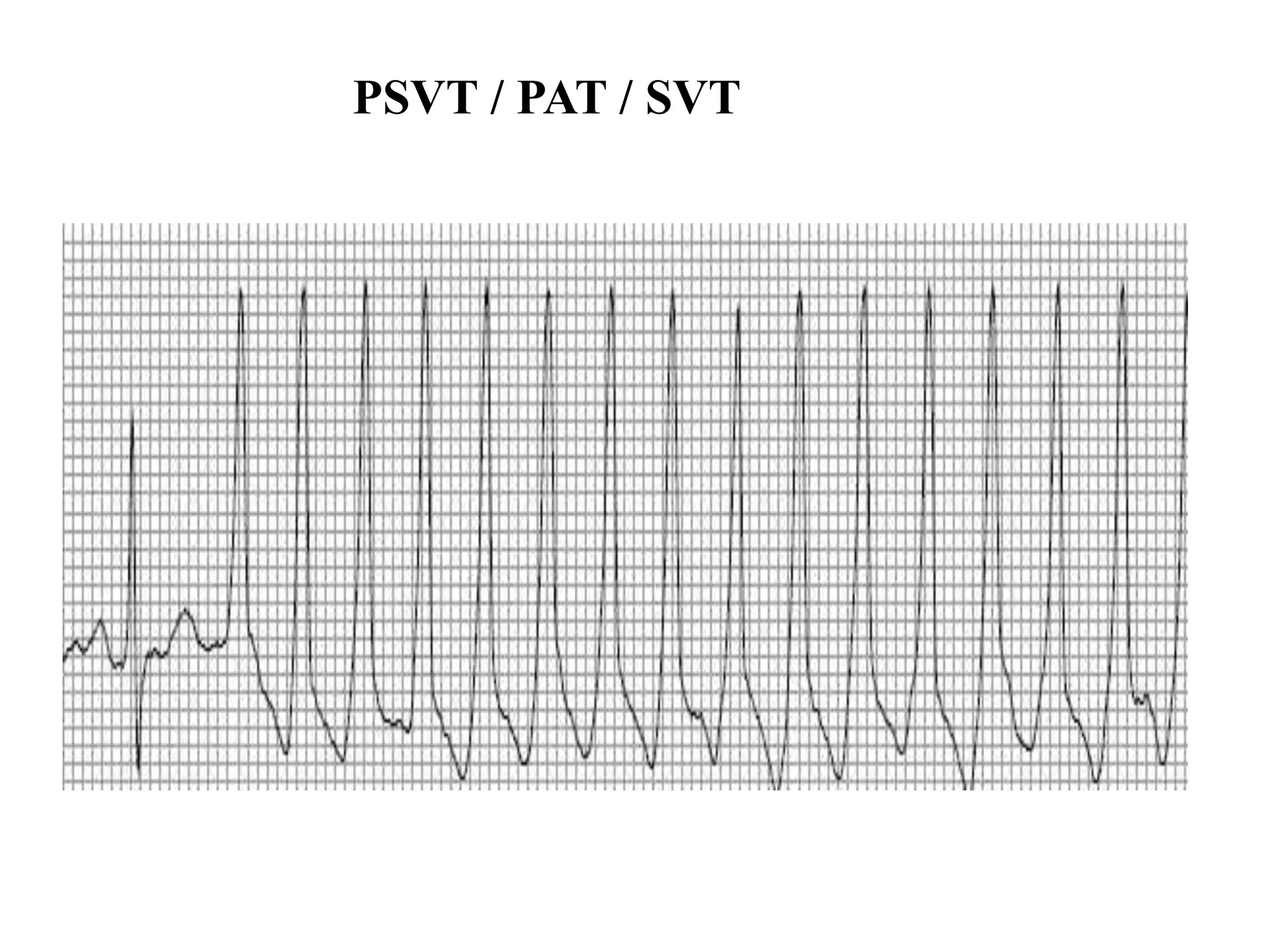 ARRHYTHMIAS ,causes, abnormal impulse conduction, | PDF