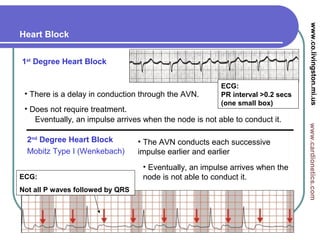 Arrhythmias | PPT