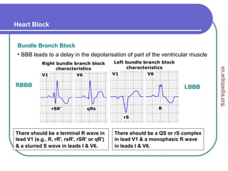 Arrhythmias | PPT