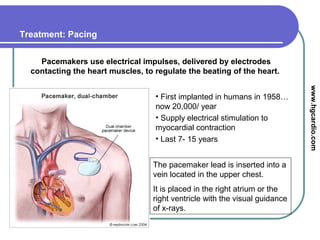 Arrhythmias | PPT