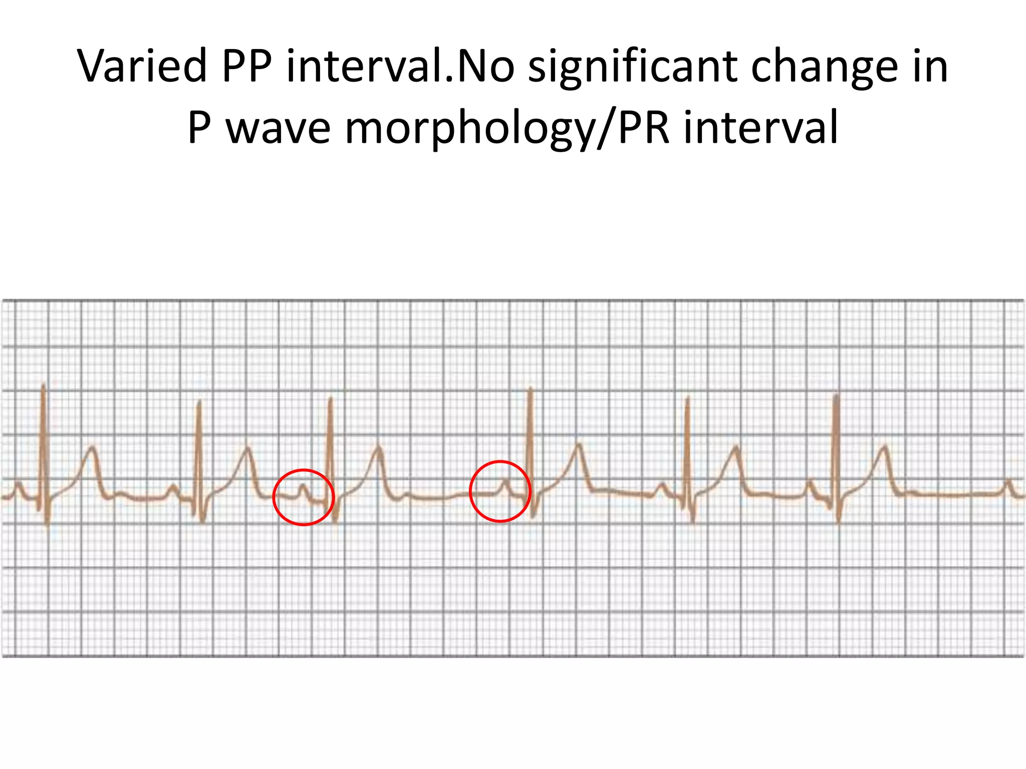Arrhythmias in children | PPTX