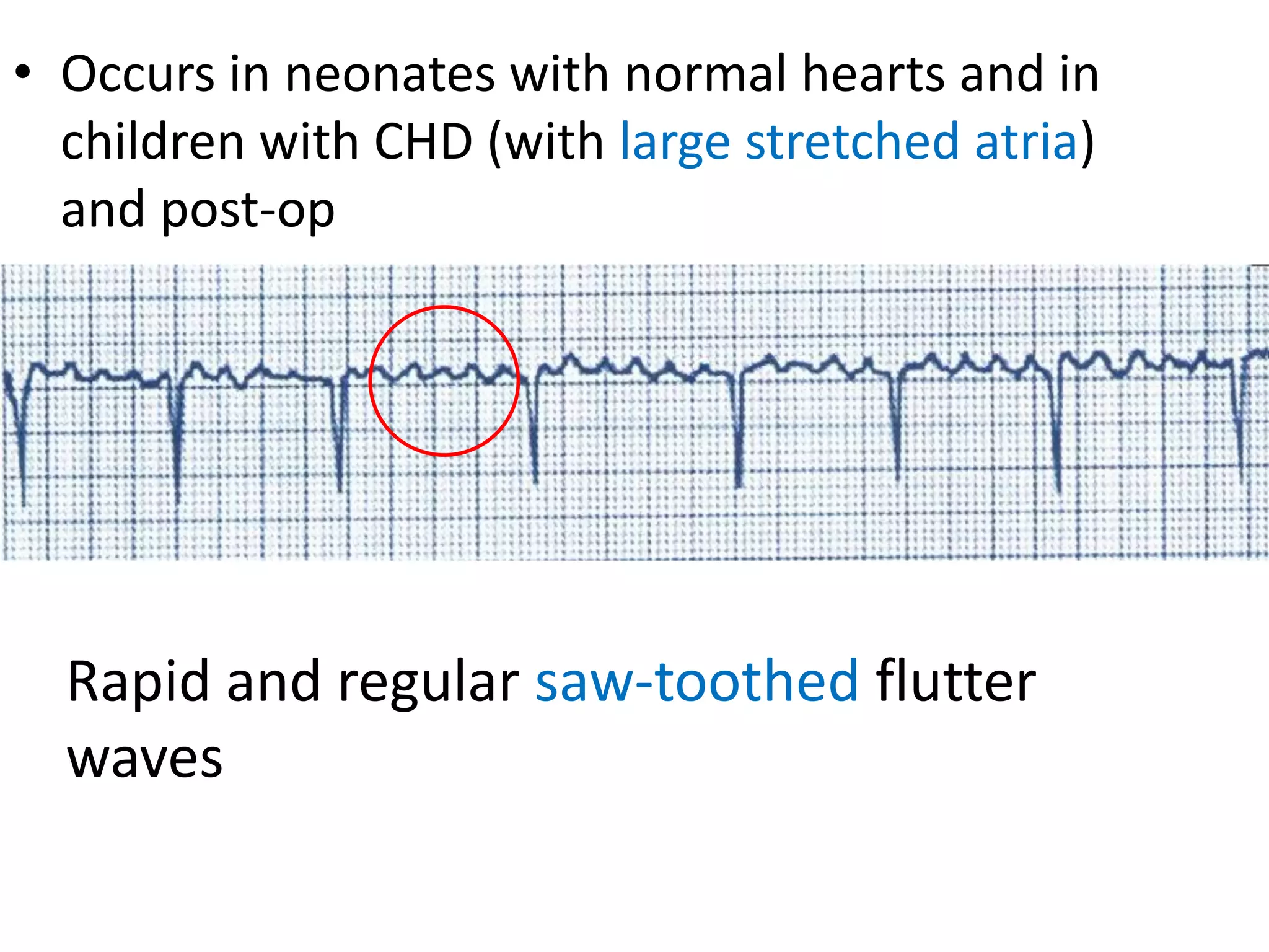 Arrhythmias in children | PPTX