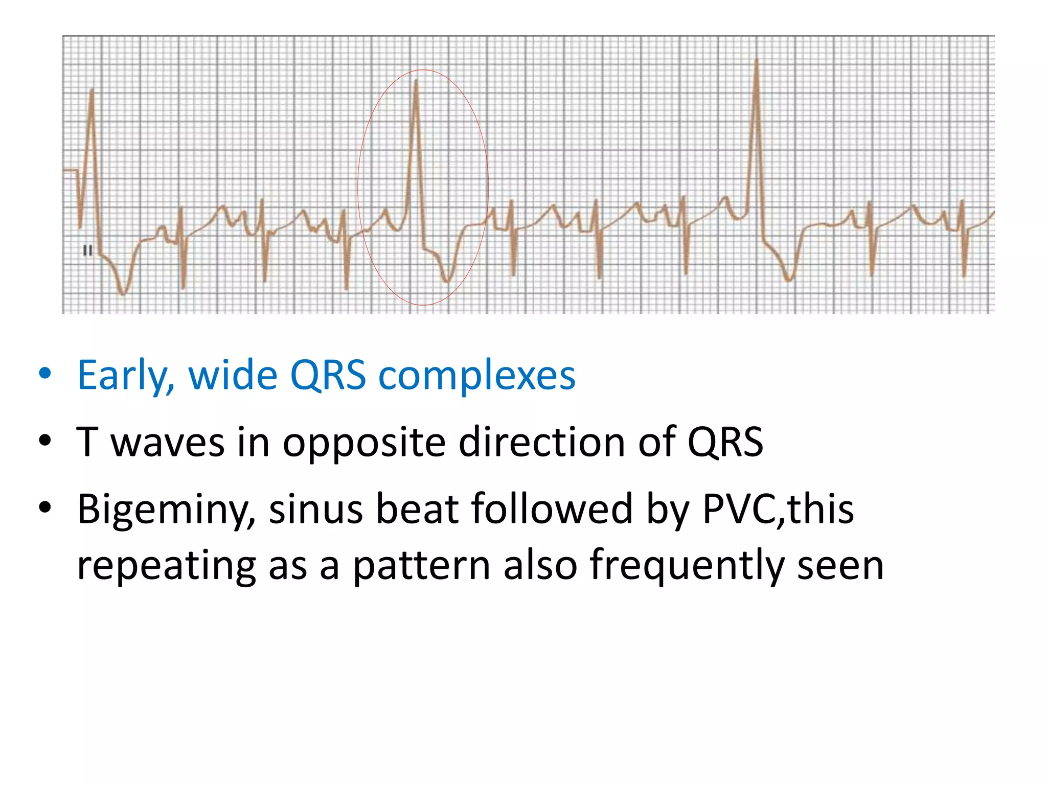 Arrhythmias in children | PPTX