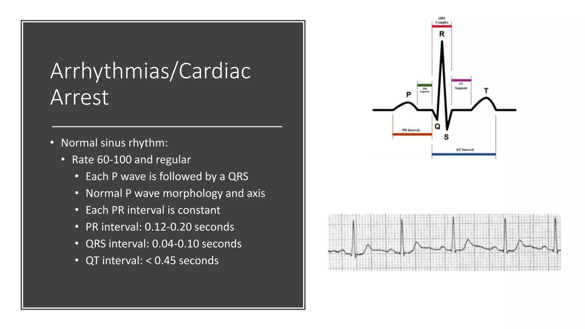 Arrhythmias & Arrest | PPT