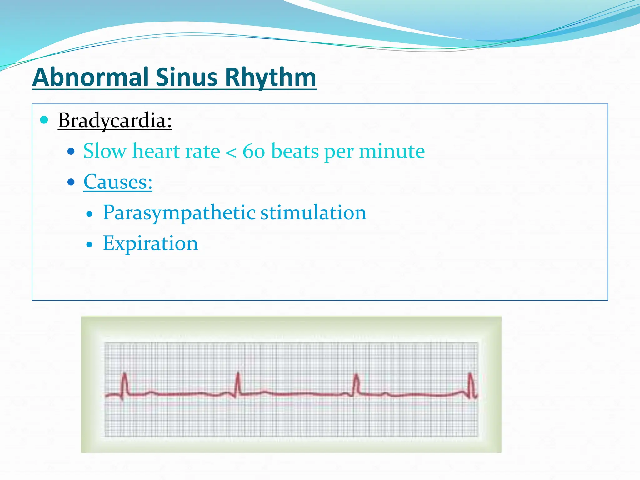 Arrhythmias copy.pptxyyyy677777777777777777 | PPT