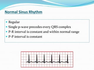 Arrhythmias copy.pptxyyyy677777777777777777 | PPTX