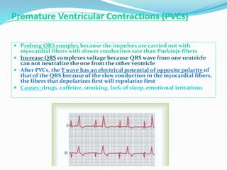 Arrhythmias copy.pptxyyyy677777777777777777 | PPT