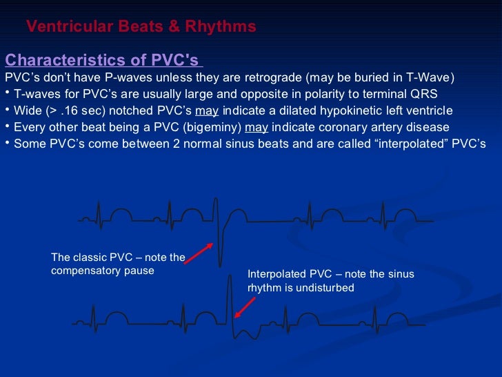 Arrhythmias general