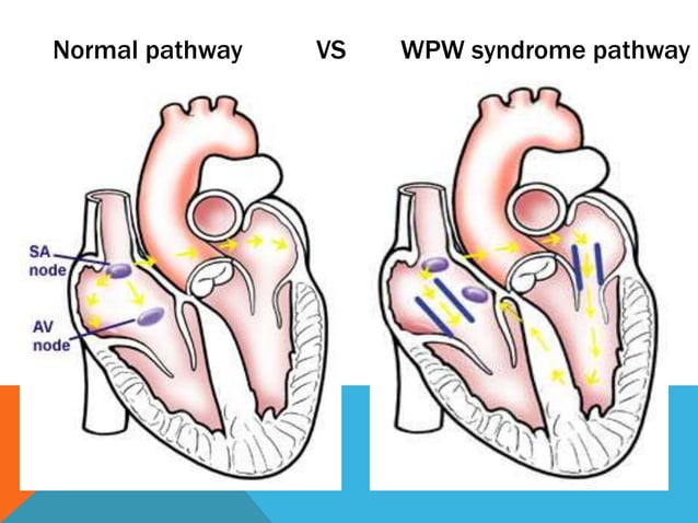 Arrhythmias, wpw syndrome, heart attack & ventricular fibrillation | PPT