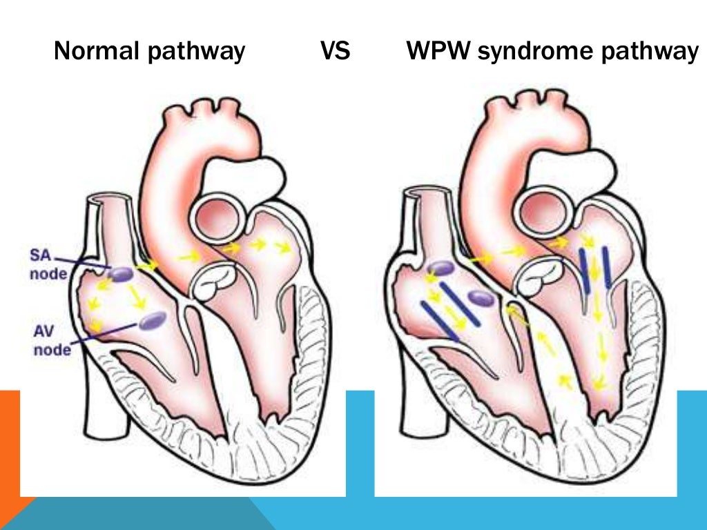 Arrhythmias, wpw syndrome, heart attack & ventricular fibrillation