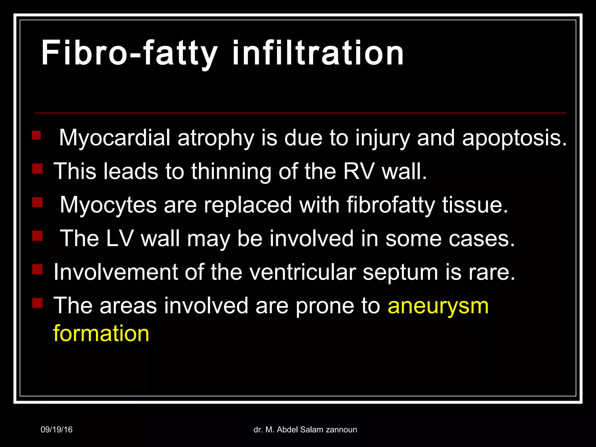 Arrhythmogenic right ventricular dysplasia | PPT