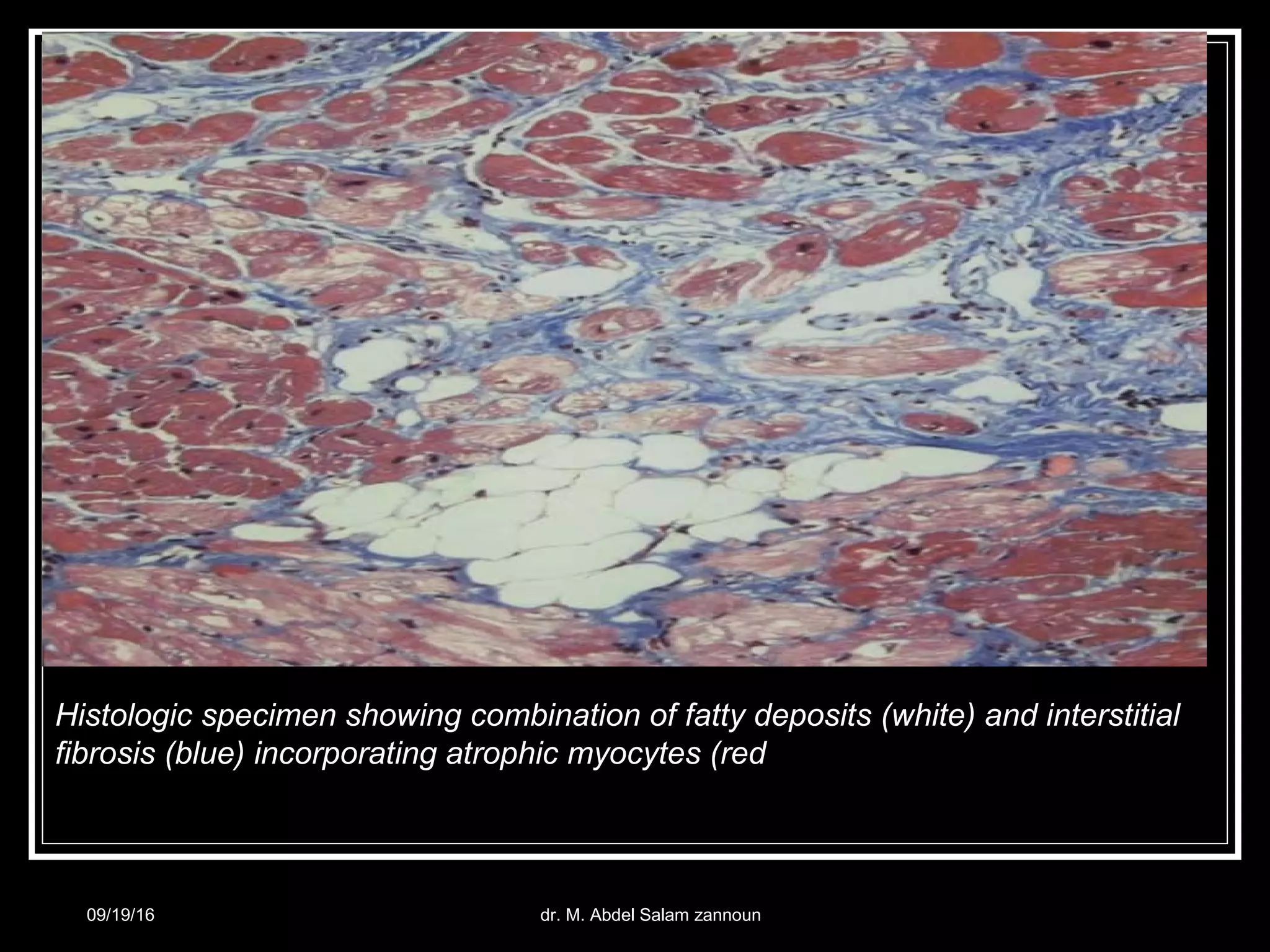 Arrhythmogenic right ventricular dysplasia | PPT