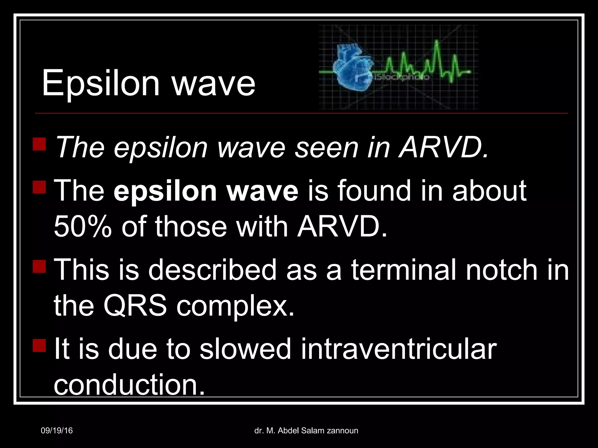 Arrhythmogenic right ventricular dysplasia | PPT
