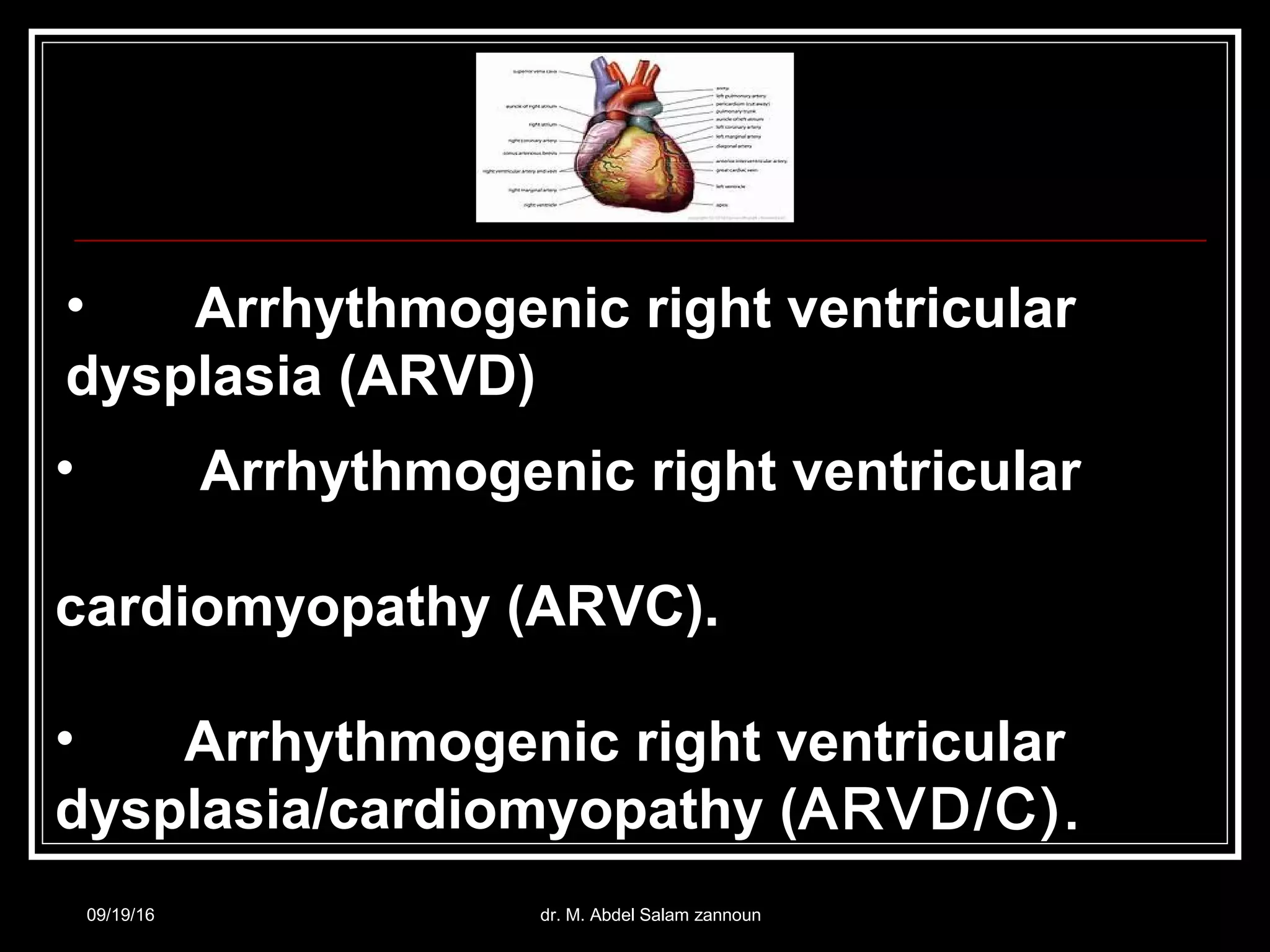 Arrhythmogenic right ventricular dysplasia | PPT