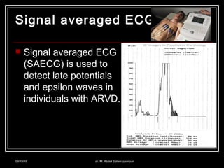 Arrhythmogenic right ventricular dysplasia | PPT