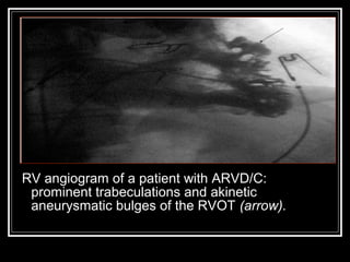Arrhythmogenic right ventricular dysplasia | PPT