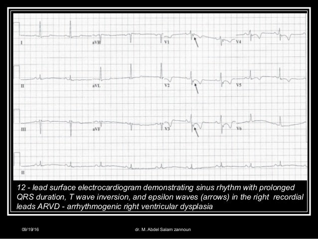 Arrhythmogenic right ventricular dysplasia