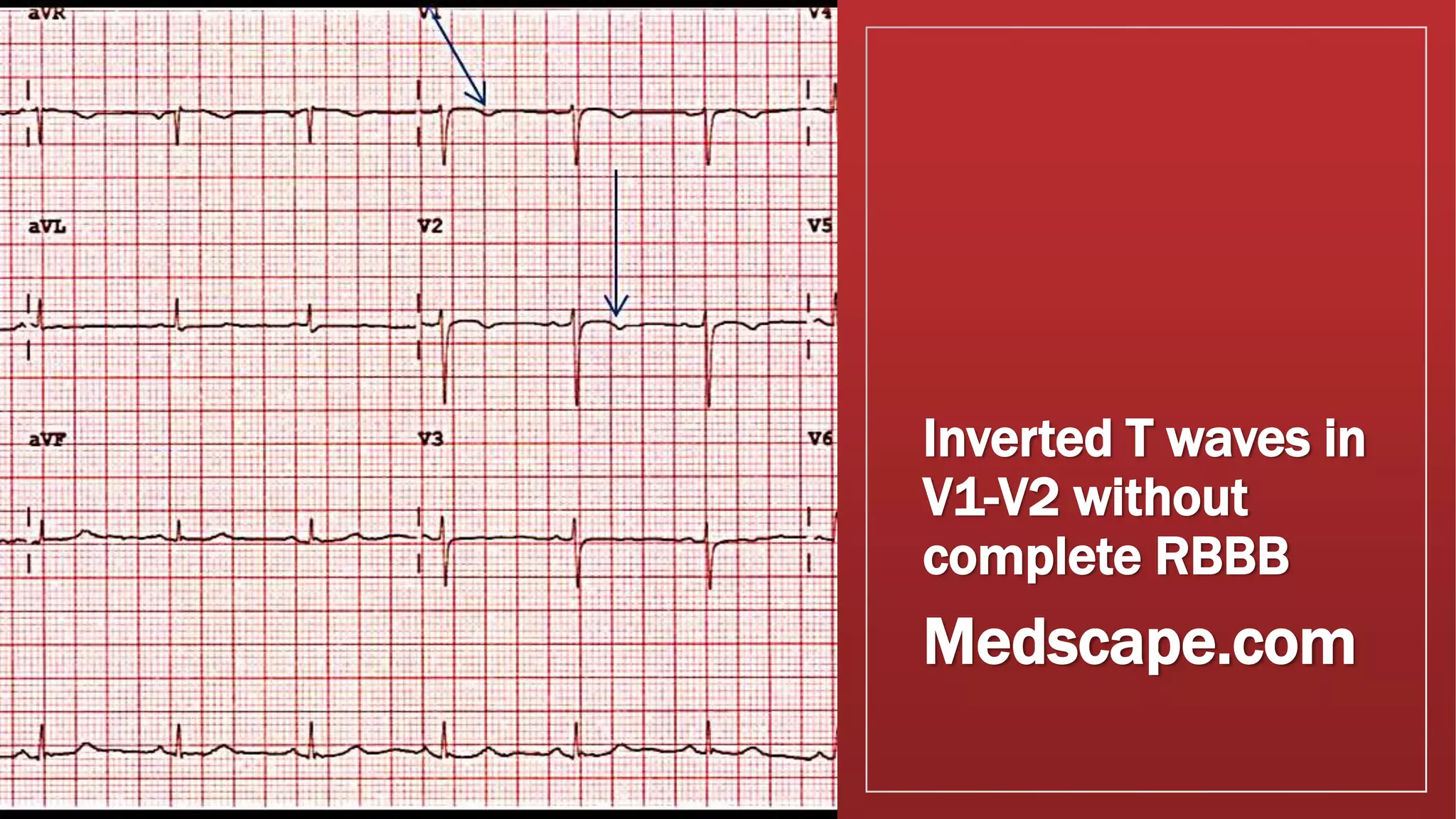 Arrhythmogenic right ventricular dysplasia | PPSX