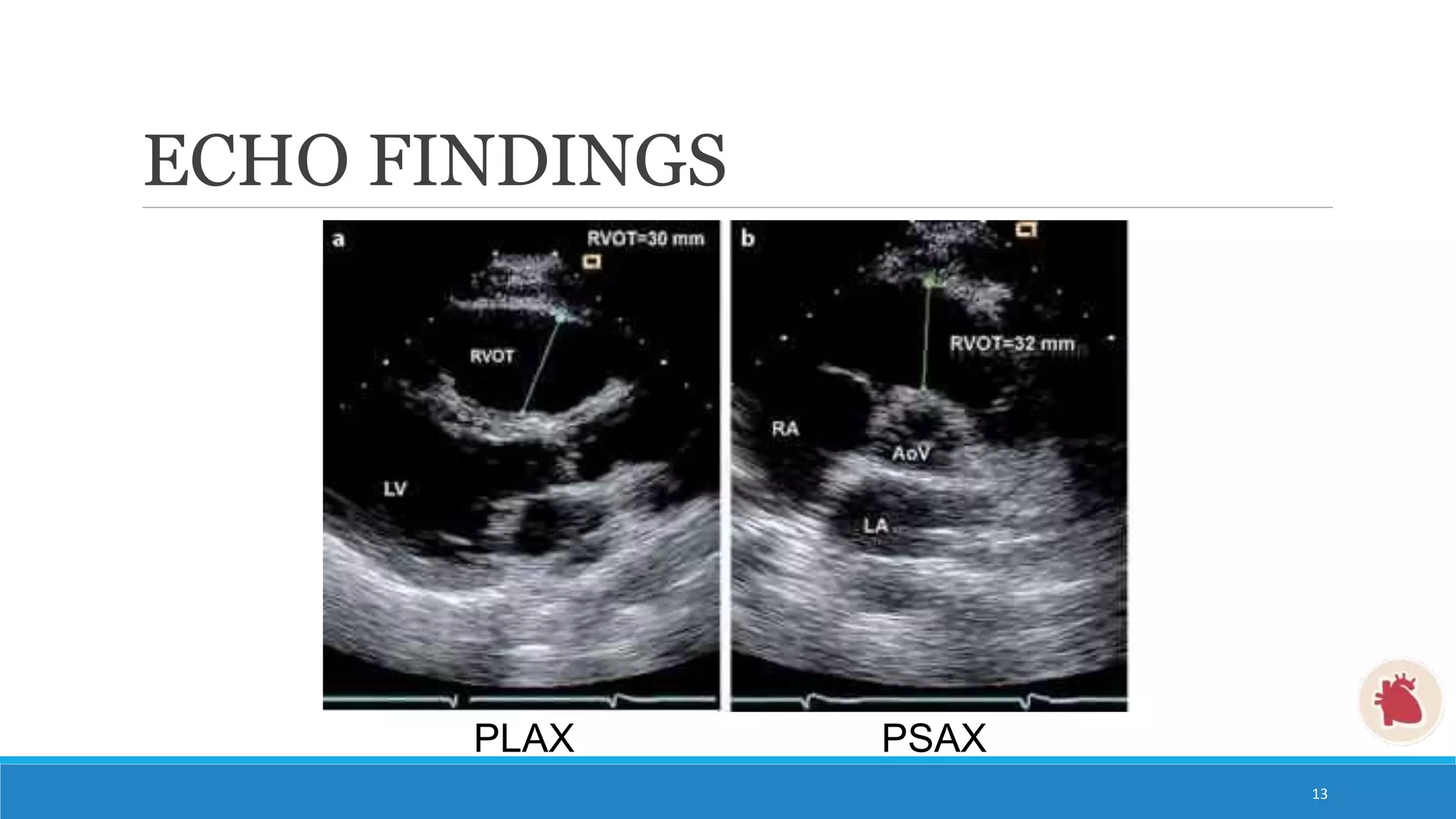 Arrhythmogenic right ventricular dysplasia - ARVD | PPTX