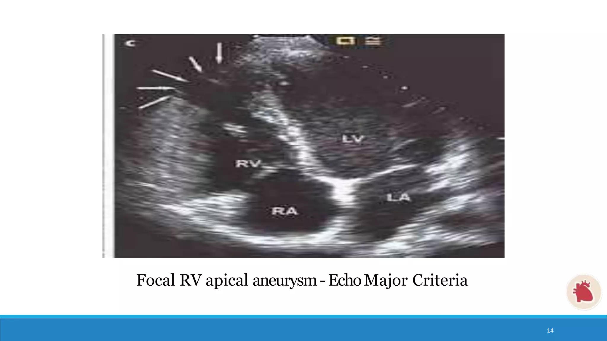 Arrhythmogenic right ventricular dysplasia - ARVD | PPTX