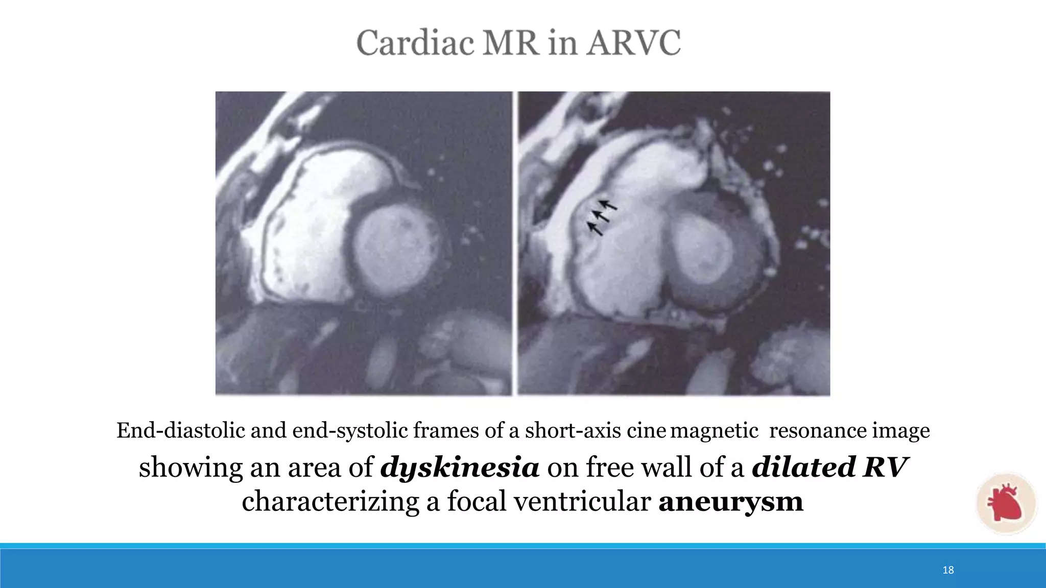Arrhythmogenic right ventricular dysplasia - ARVD | PPTX