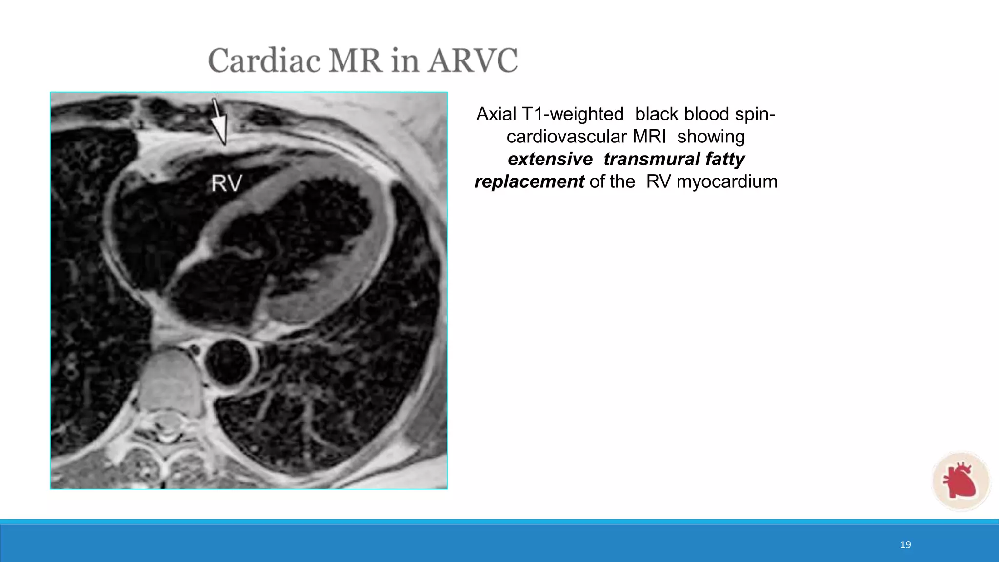 Arrhythmogenic right ventricular dysplasia - ARVD | PPTX