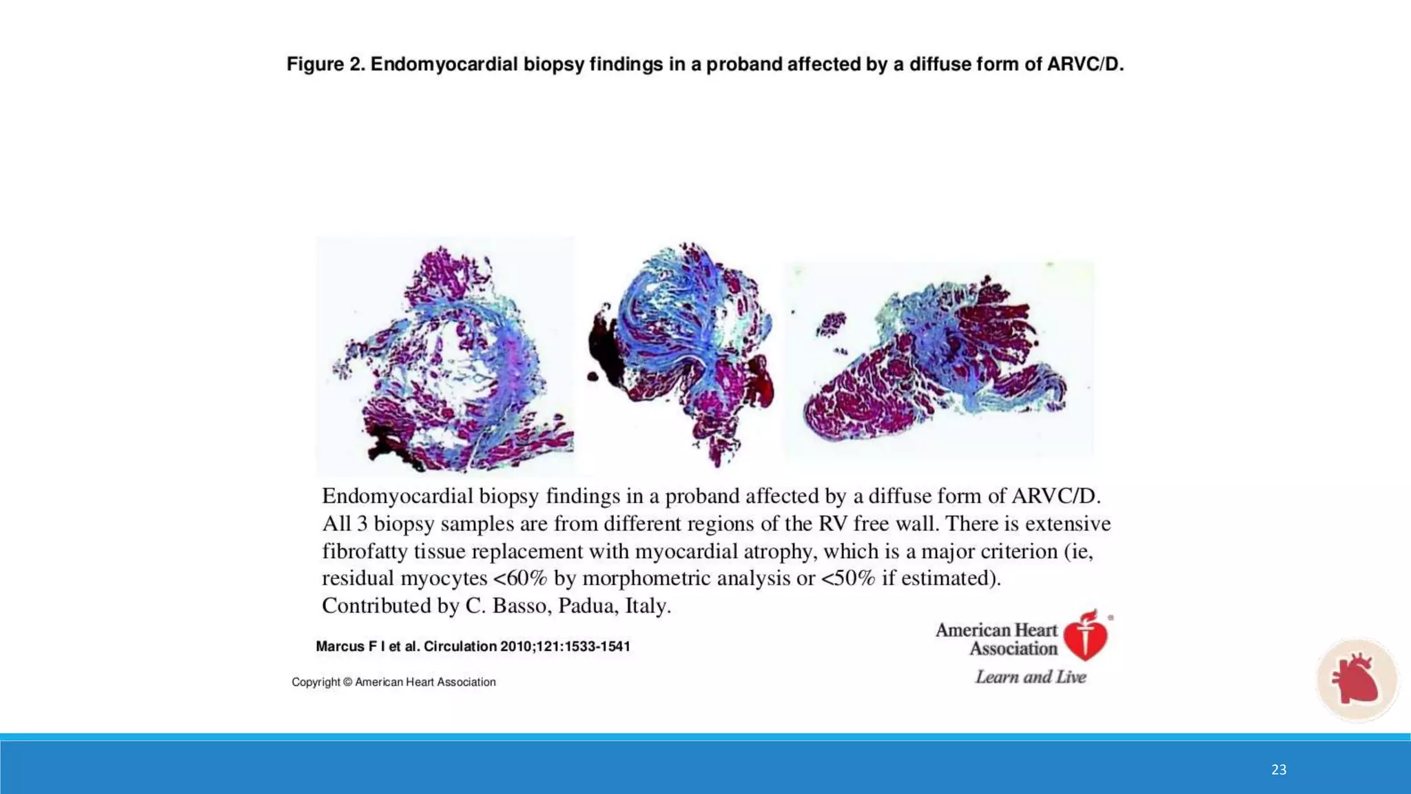 Arrhythmogenic right ventricular dysplasia - ARVD | PPTX