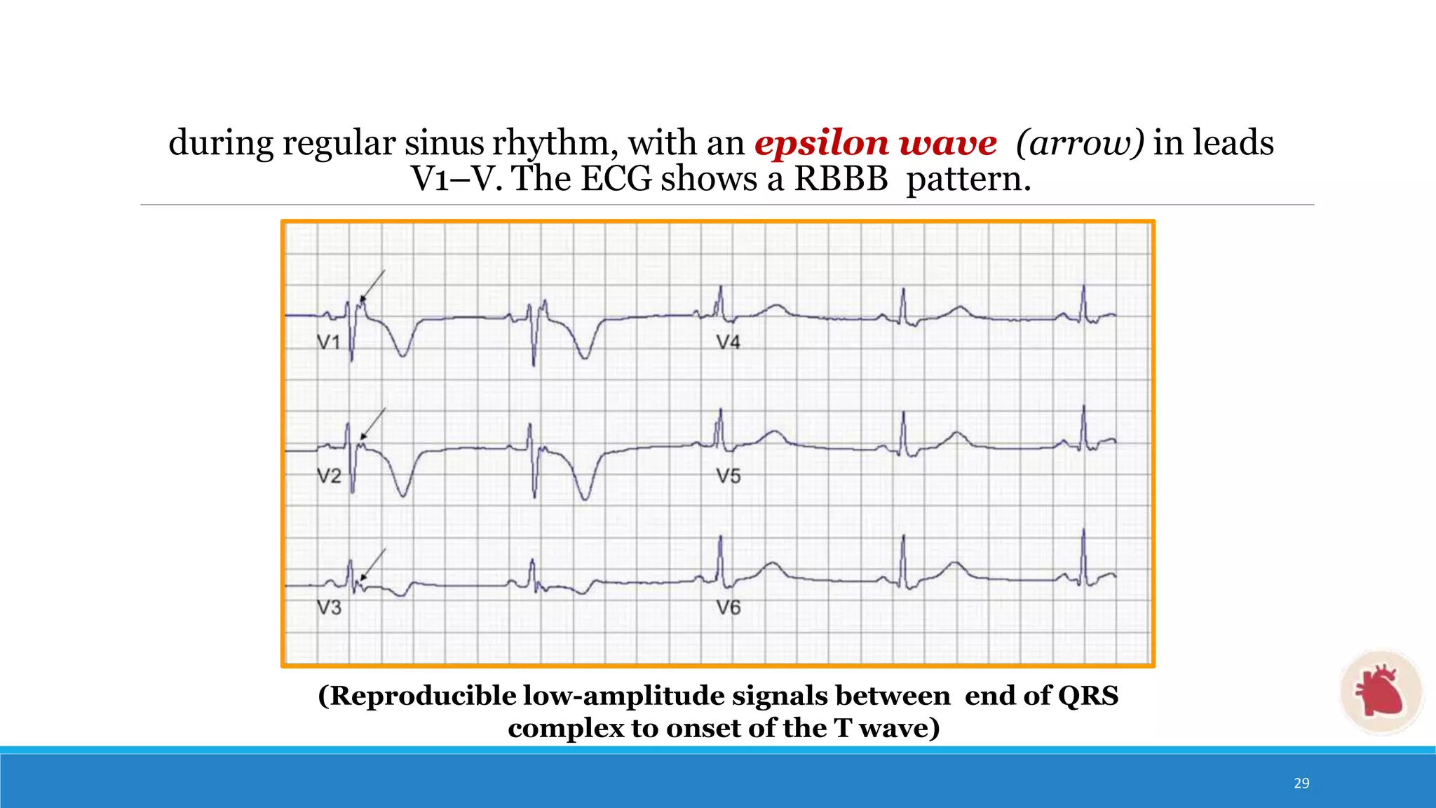 Arrhythmogenic right ventricular dysplasia - ARVD | PPTX