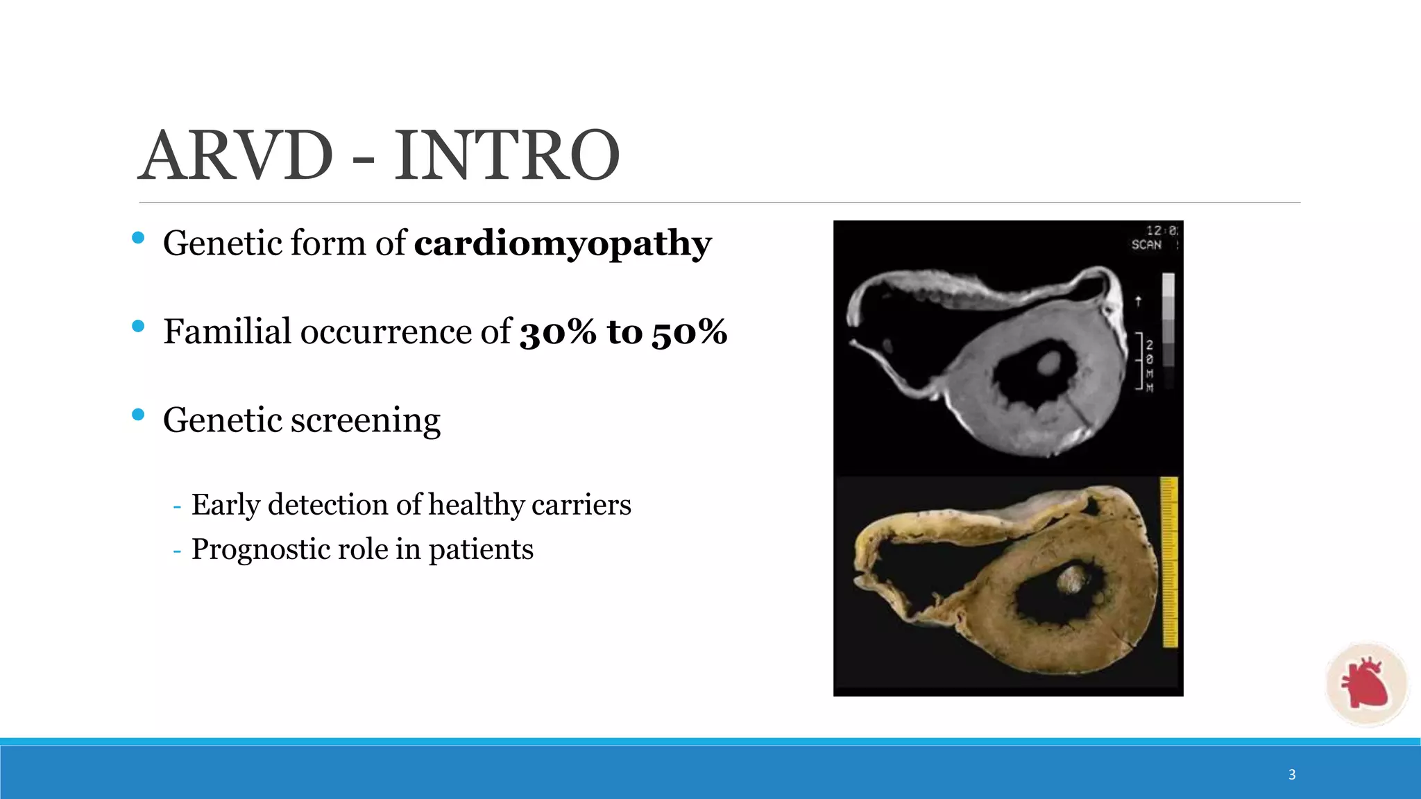 Arrhythmogenic right ventricular dysplasia - ARVD | PPTX