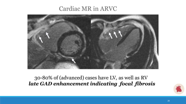 Arrhythmogenic right ventricular dysplasia - ARVD | PPTX