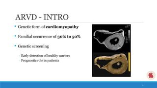 Arrhythmogenic right ventricular dysplasia - ARVD | PPTX