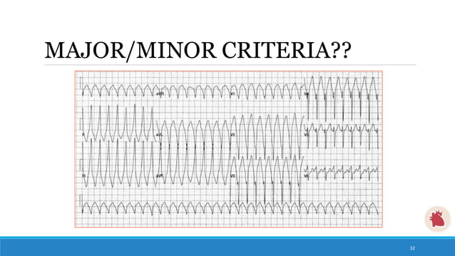 Arrhythmogenic right ventricular dysplasia - ARVD | PPTX