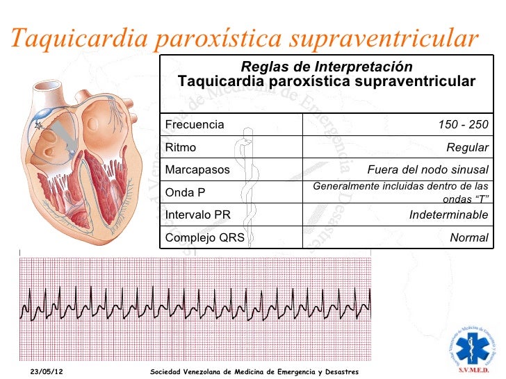 Tira De Ecg Para Taquicardia Supraventricular Paroxistica Taquicardia