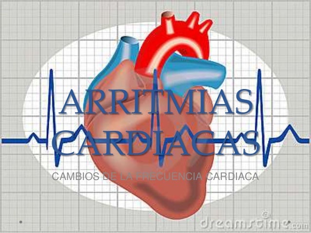 Arritmias cardiacas