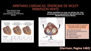 Arritmias cardiacas: Síndrome de Wolf Parkinson White /Tratamiento | PPTX