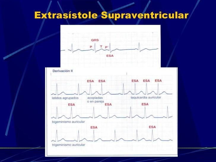 Arritmias En PediatríA