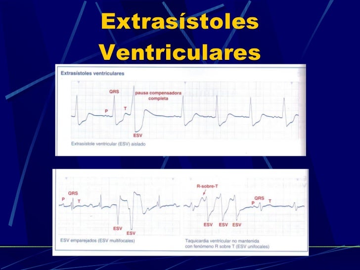 Arritmias En PediatríA